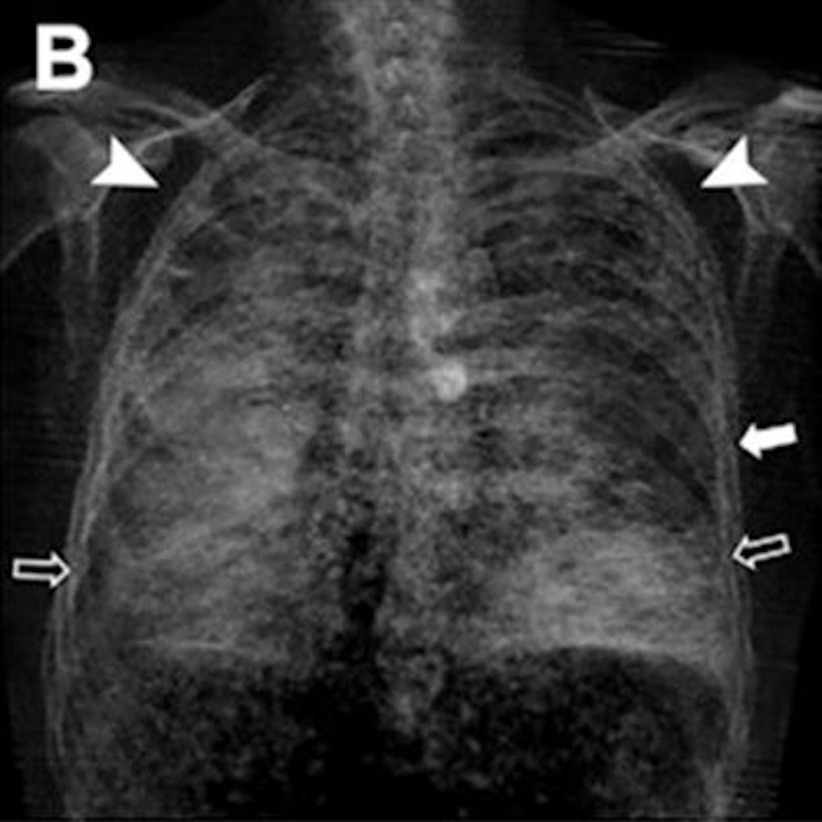 German study shows dark-field chest x-ray differentiates lung disease ...