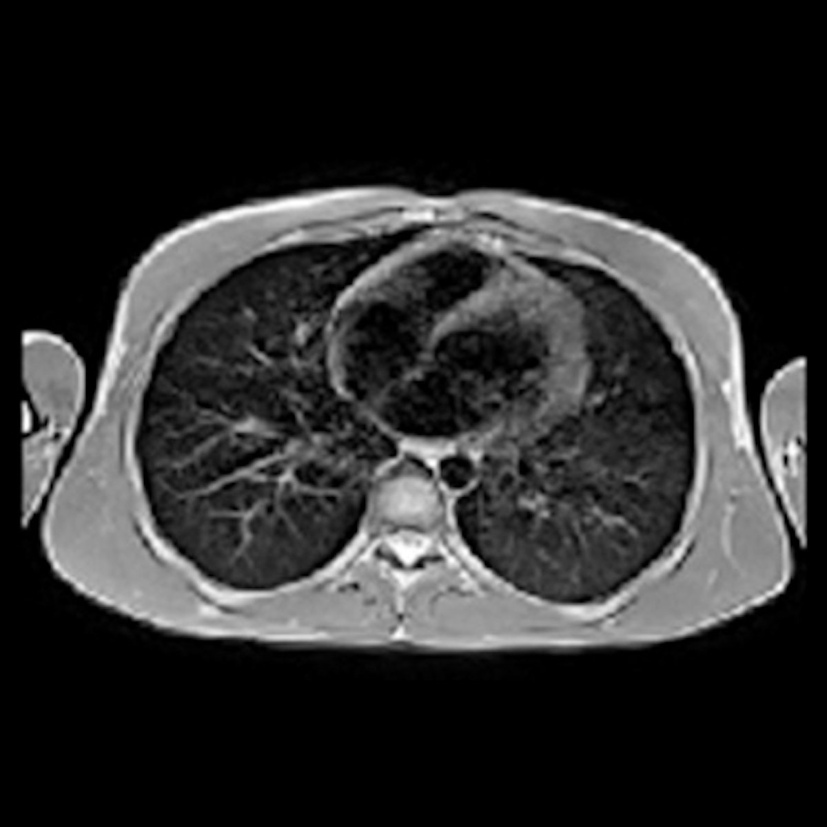 Low-field MRI proves value in monitoring COVID-19 lung damage ...