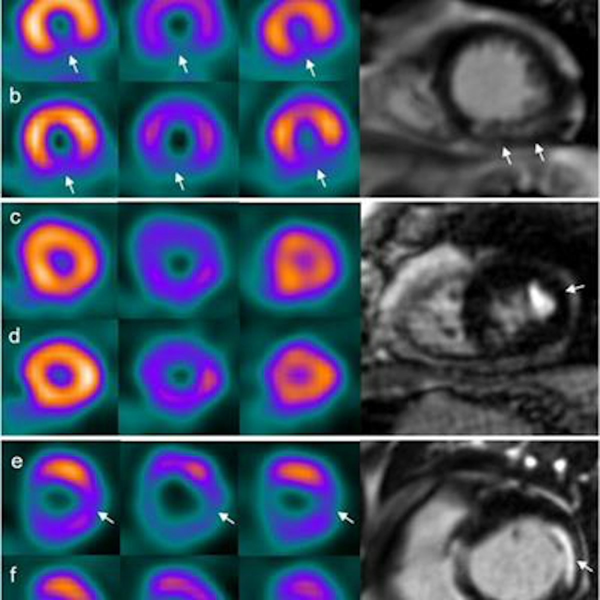 SPECT comparable to conventional gamma for detecting heart attack ...