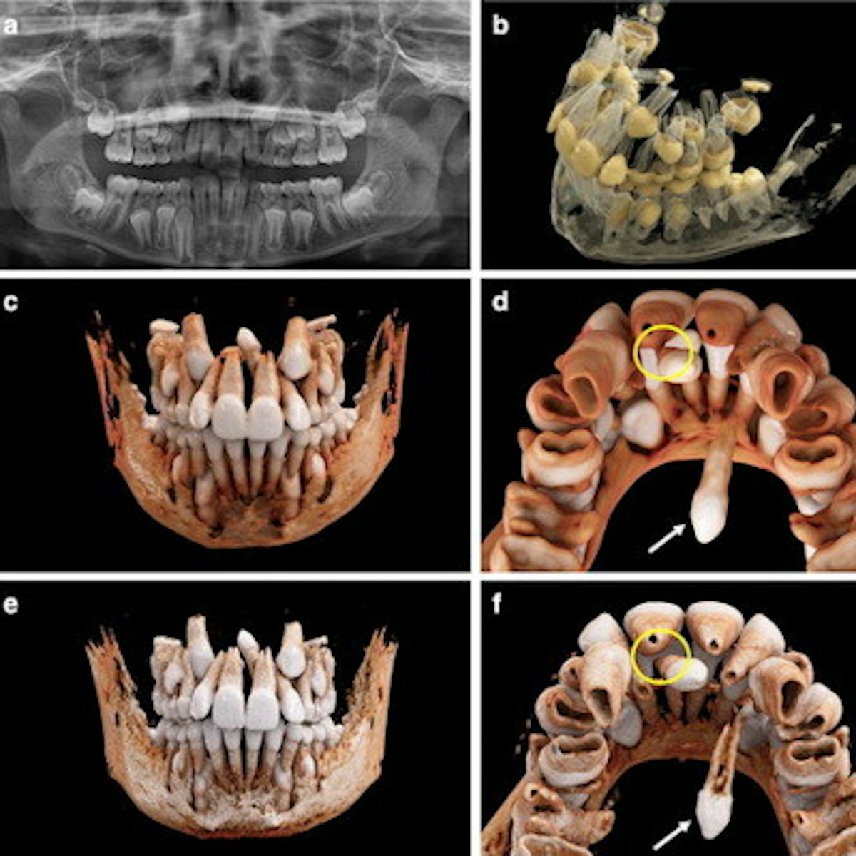 Modified imaging tool visualizes teeth segmented from bone ...