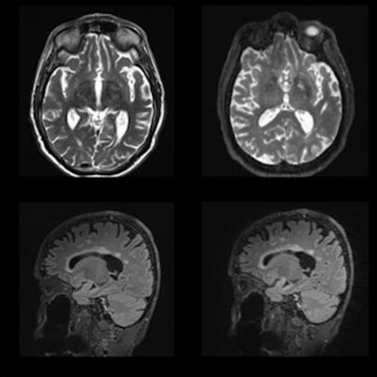 Ultrafast MRI protocol can cut dementia diagnosis time by over 60% ...
