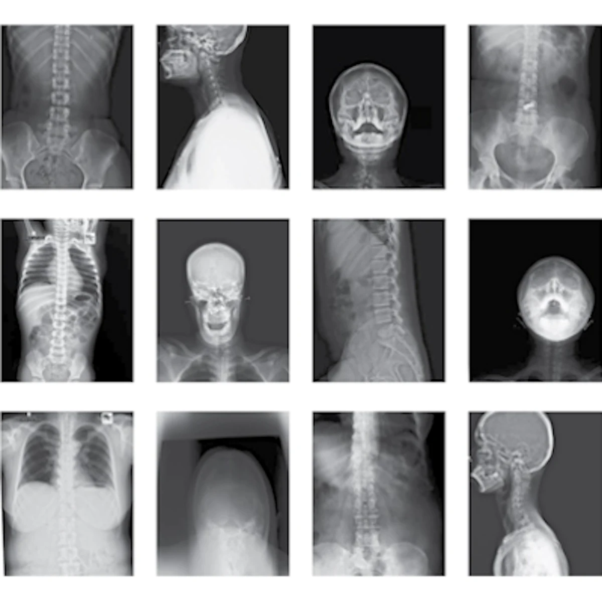 Research group unveils AI x-ray dataset for bone fracture diagnosis ...