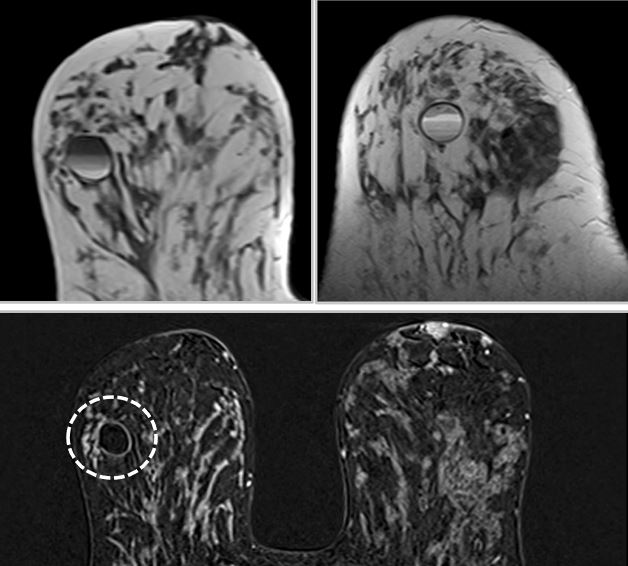 Get to know vital radiological signs in breast imaging | AuntMinnieEurope