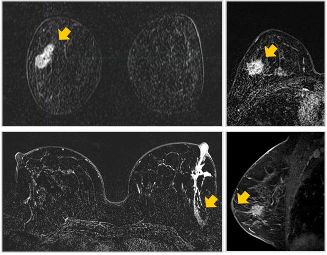 Get to know vital radiological signs in breast imaging | AuntMinnieEurope