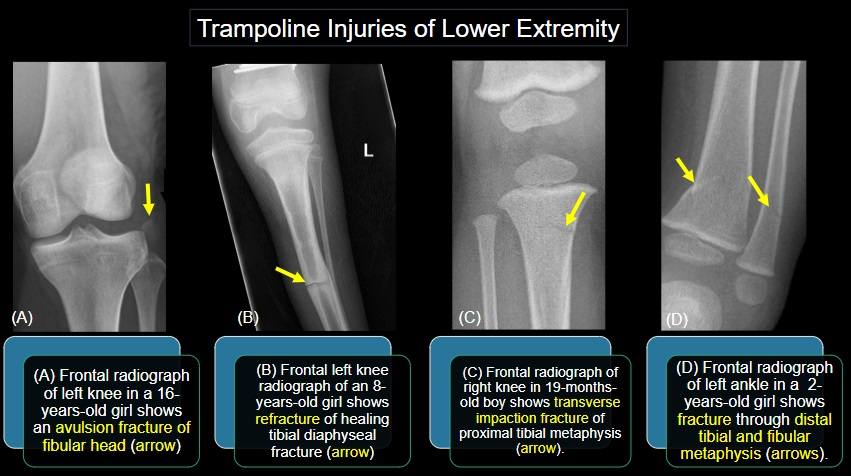 Trampoline-related injuries span head to toe in children | AuntMinnieEurope