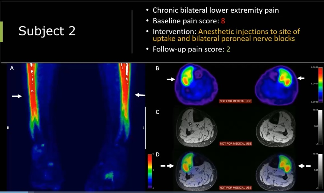 New PET tracer visualizes drivers of chronic pain | AuntMinnieEurope