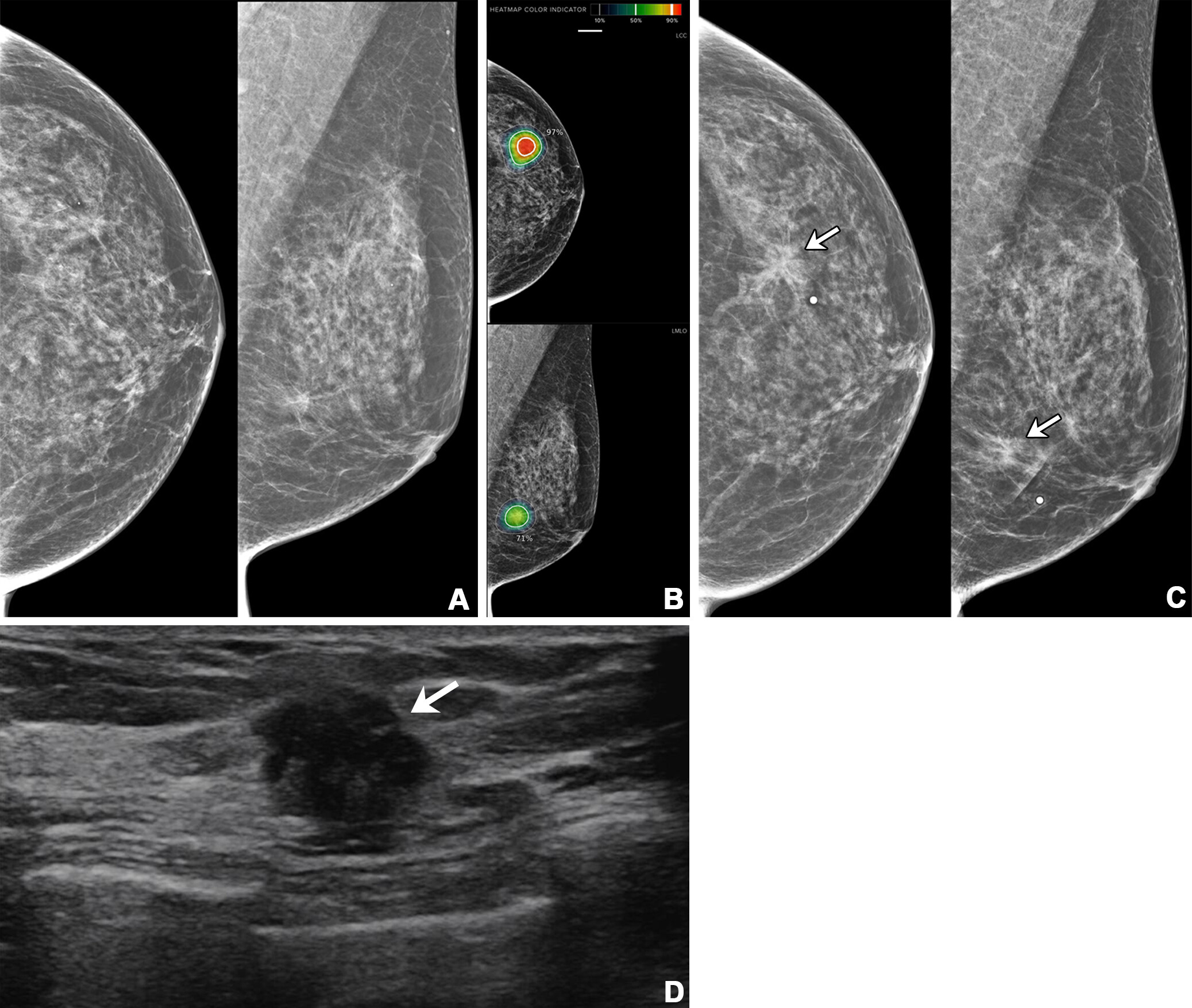 Mammo AI falls short to ultrasound in screening dense breasts ...