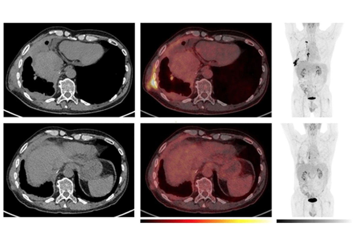 PET/CT provides clarity in pleural mesothelioma cases | AuntMinnieEurope
