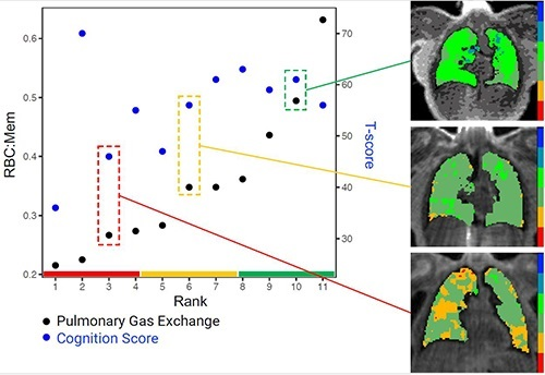 MRI links long-COVID brain fog to lung function | AuntMinnieEurope