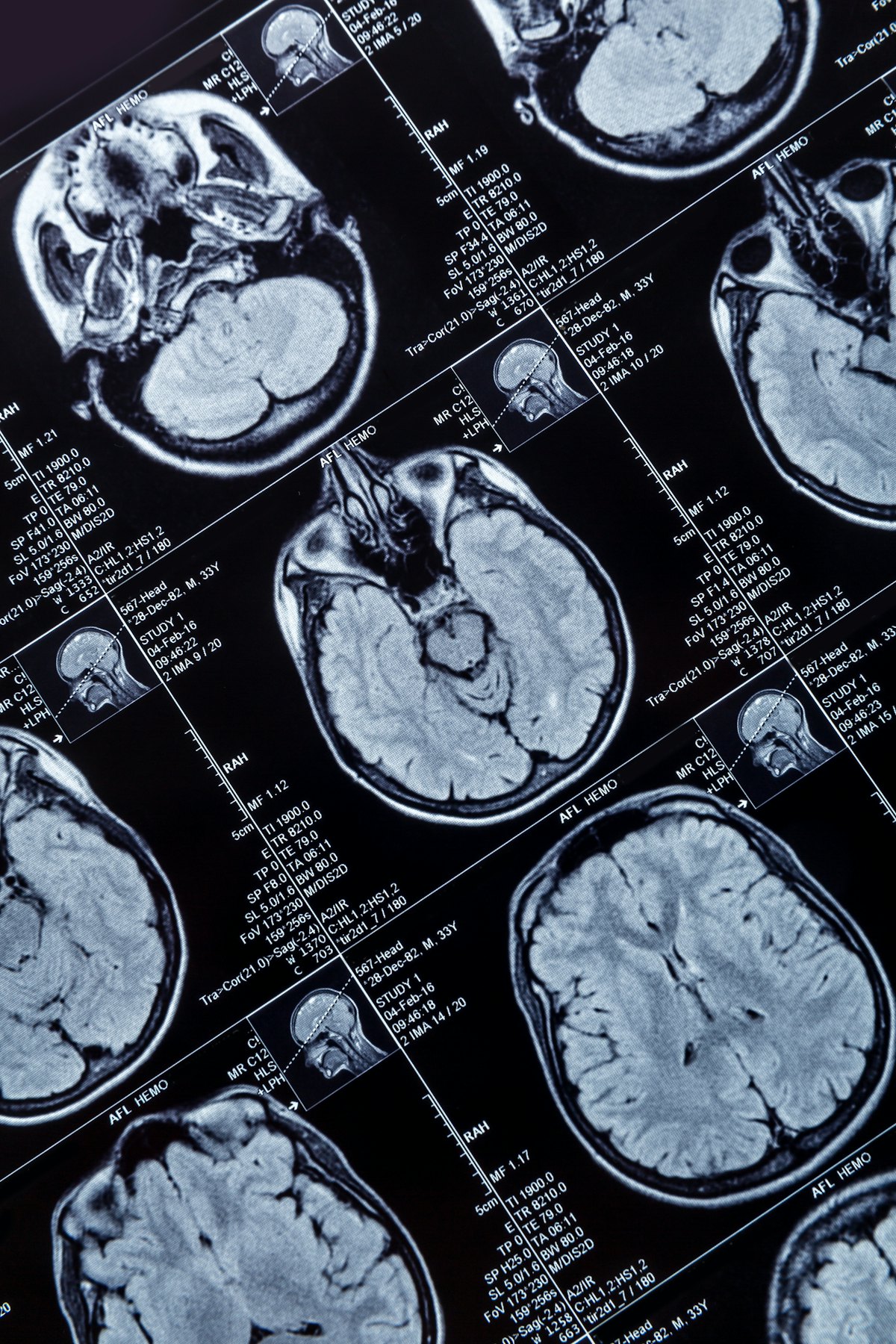 AI algorithm harmonizes MRI data from different vendors | AuntMinnieEurope