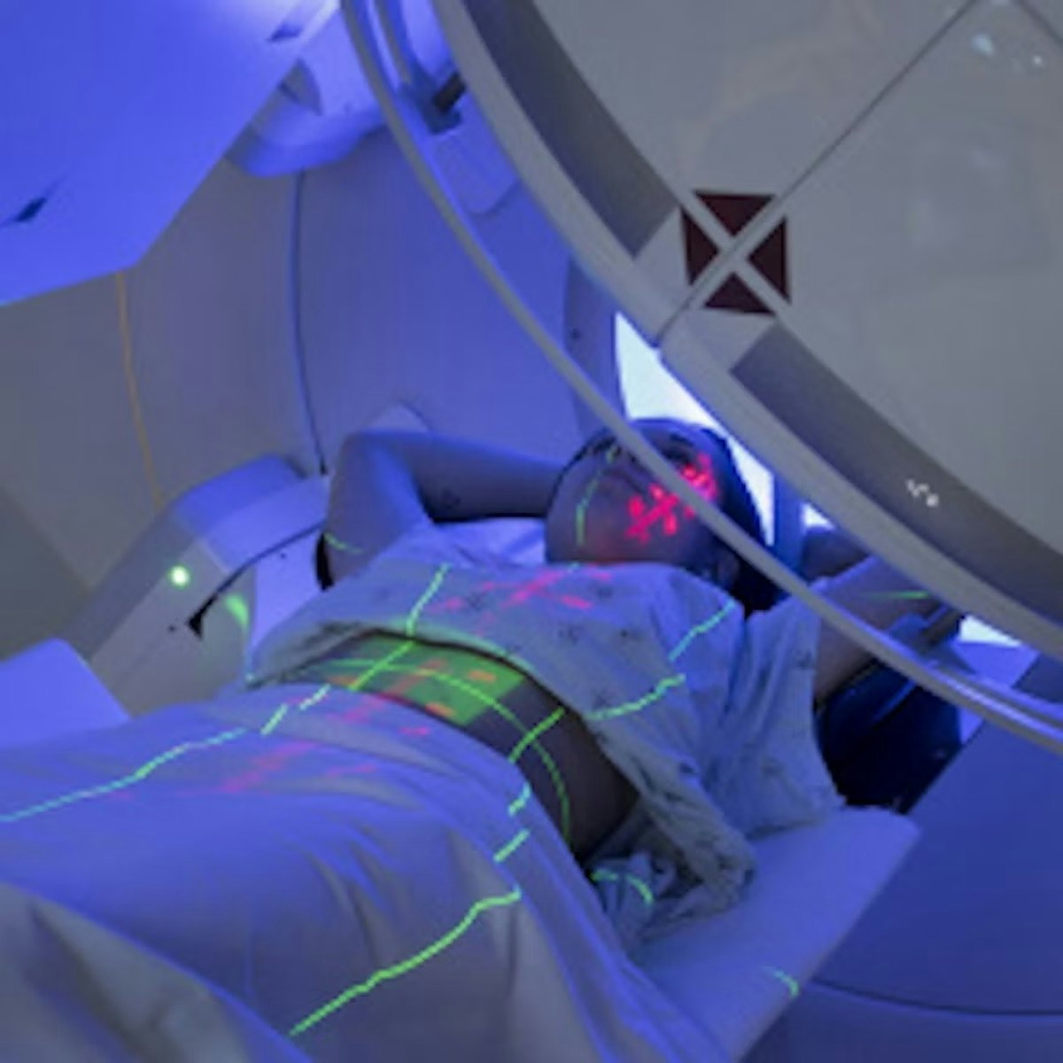 RCR issues advice on autocontouring in radiotherapy | AuntMinnieEurope