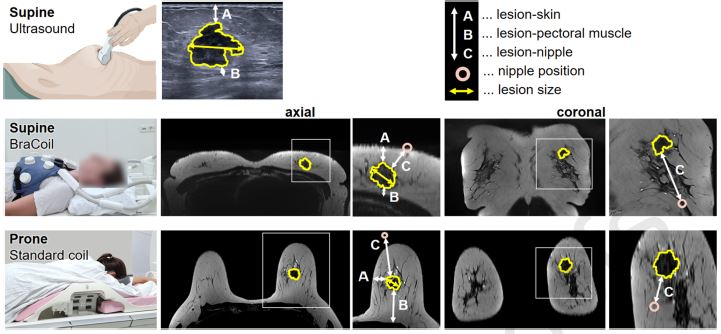 Wearable Coil For Breast Mri Can Bring Major Clinical Benefits