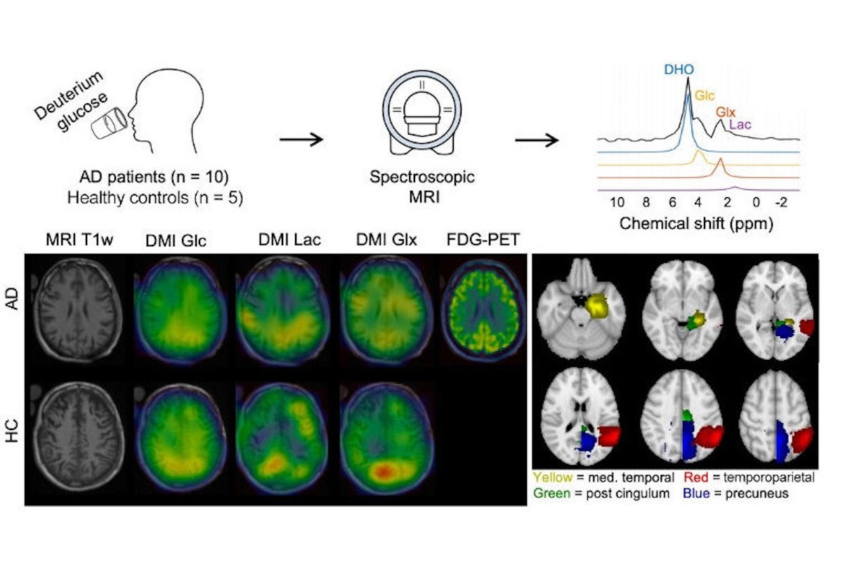 Metabolic MRI method shows promise in Alzheimer’s cases | AuntMinnieEurope