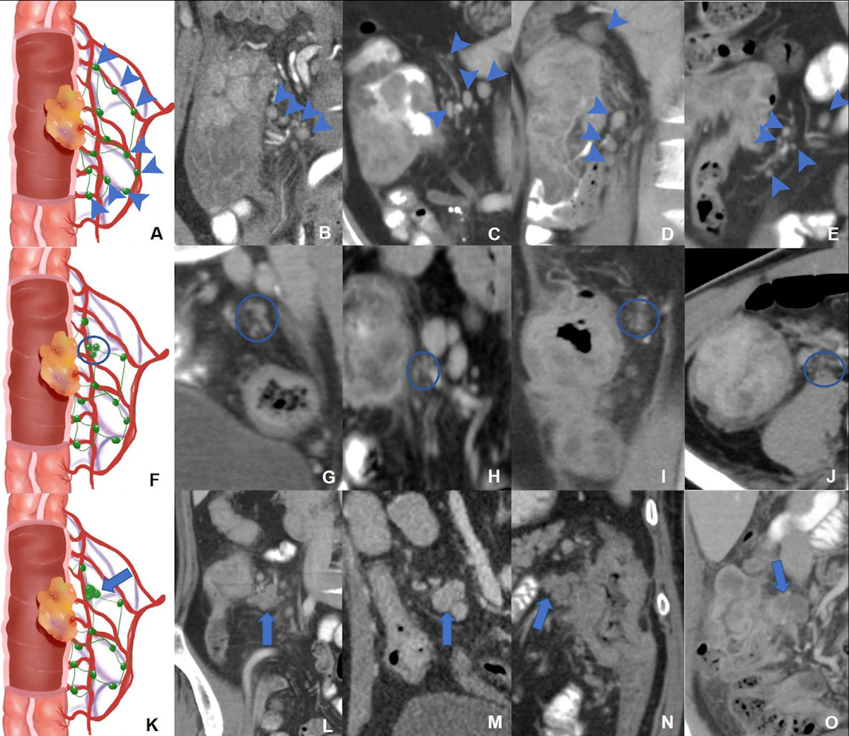 CT effective for tracking colon cancer lymph node distribution ...