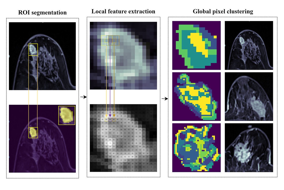 MRI Nomogram Improves Breast Cancer Prediction – Archyde: Latest World ...