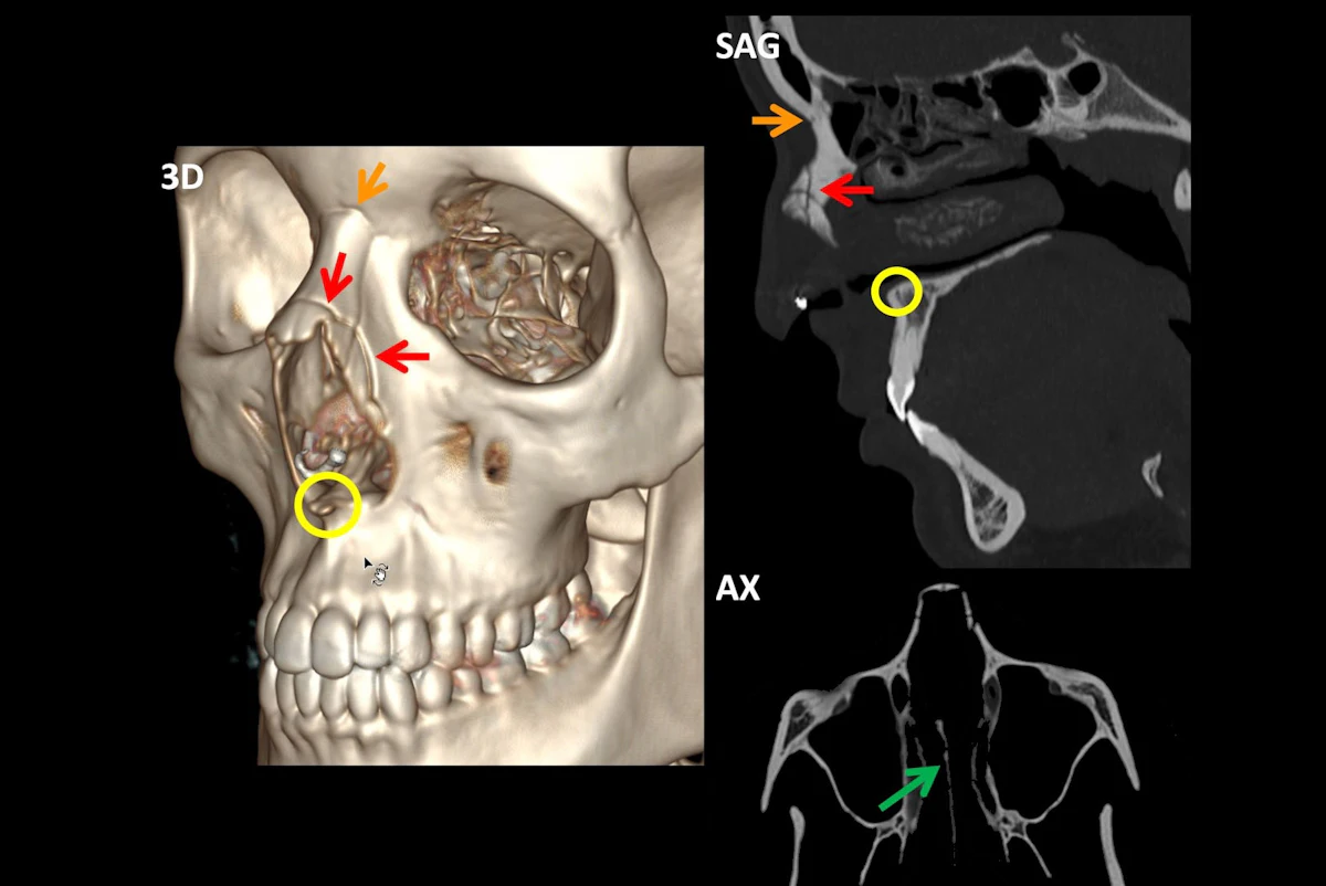 CT brings hope in complex cases of facial trauma | AuntMinnieEurope