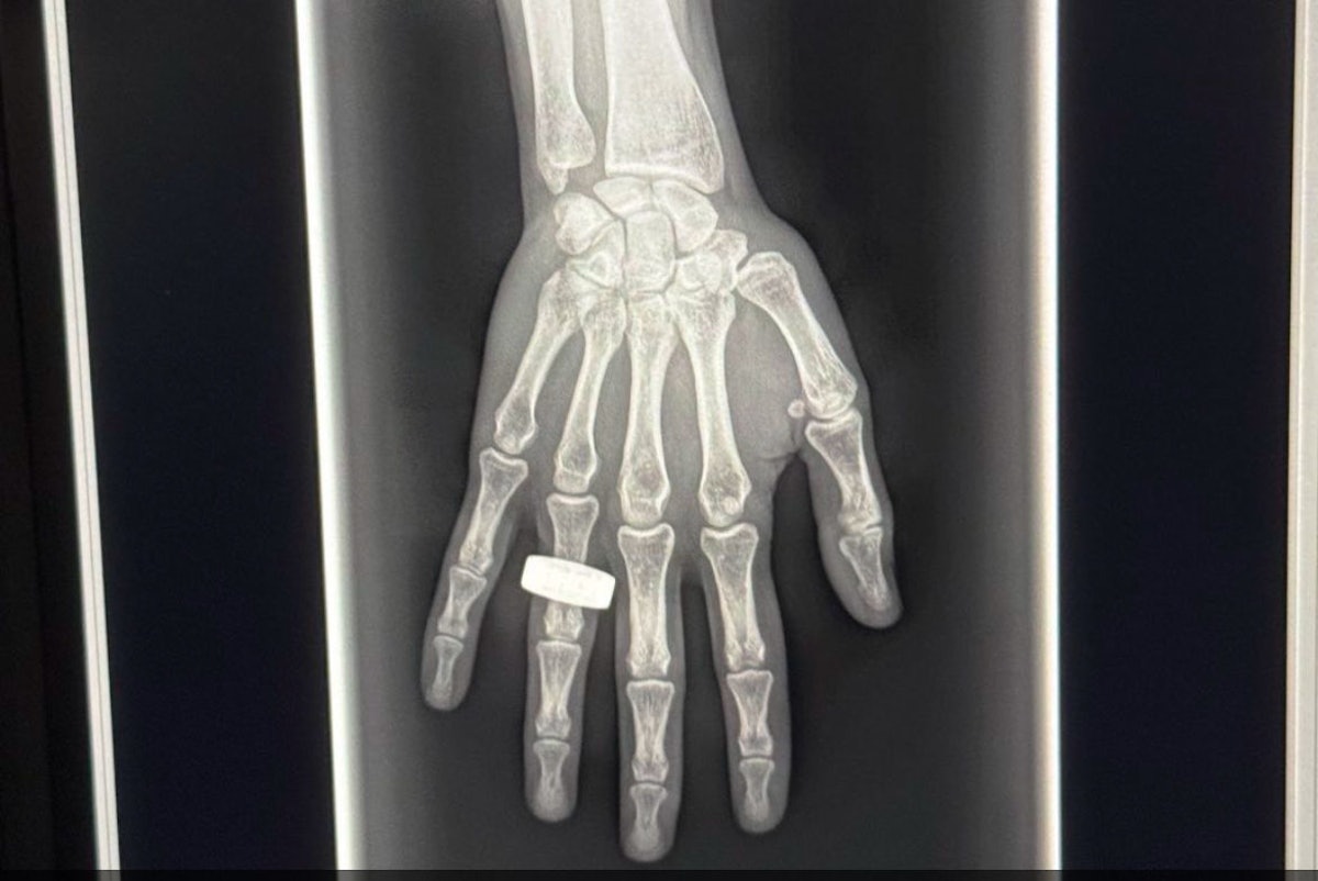 Is this the first x-ray image taken in space? | AuntMinnieEurope