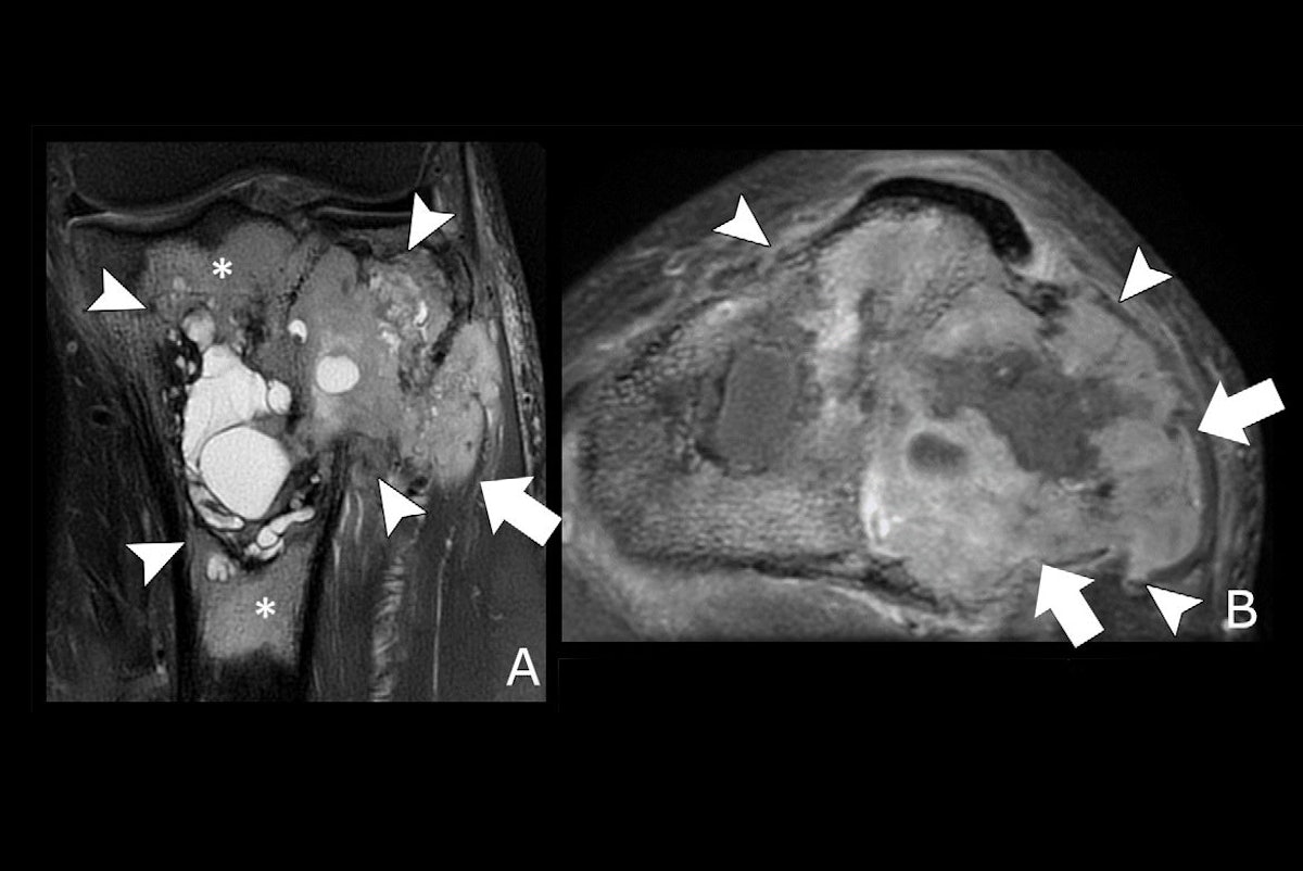 Machine learning standardizes bone tumor grading on MRI, CT ...