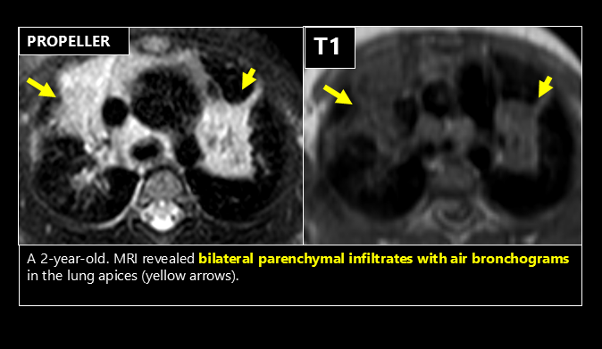 Lung MRI proves viable alternative to CT for thoracic imaging ...