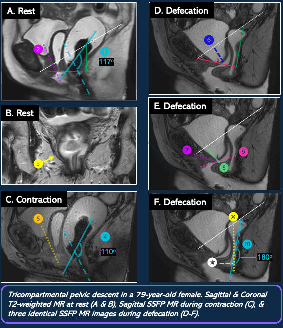 MRI proves value in pelvic floor disorders | AuntMinnieEurope