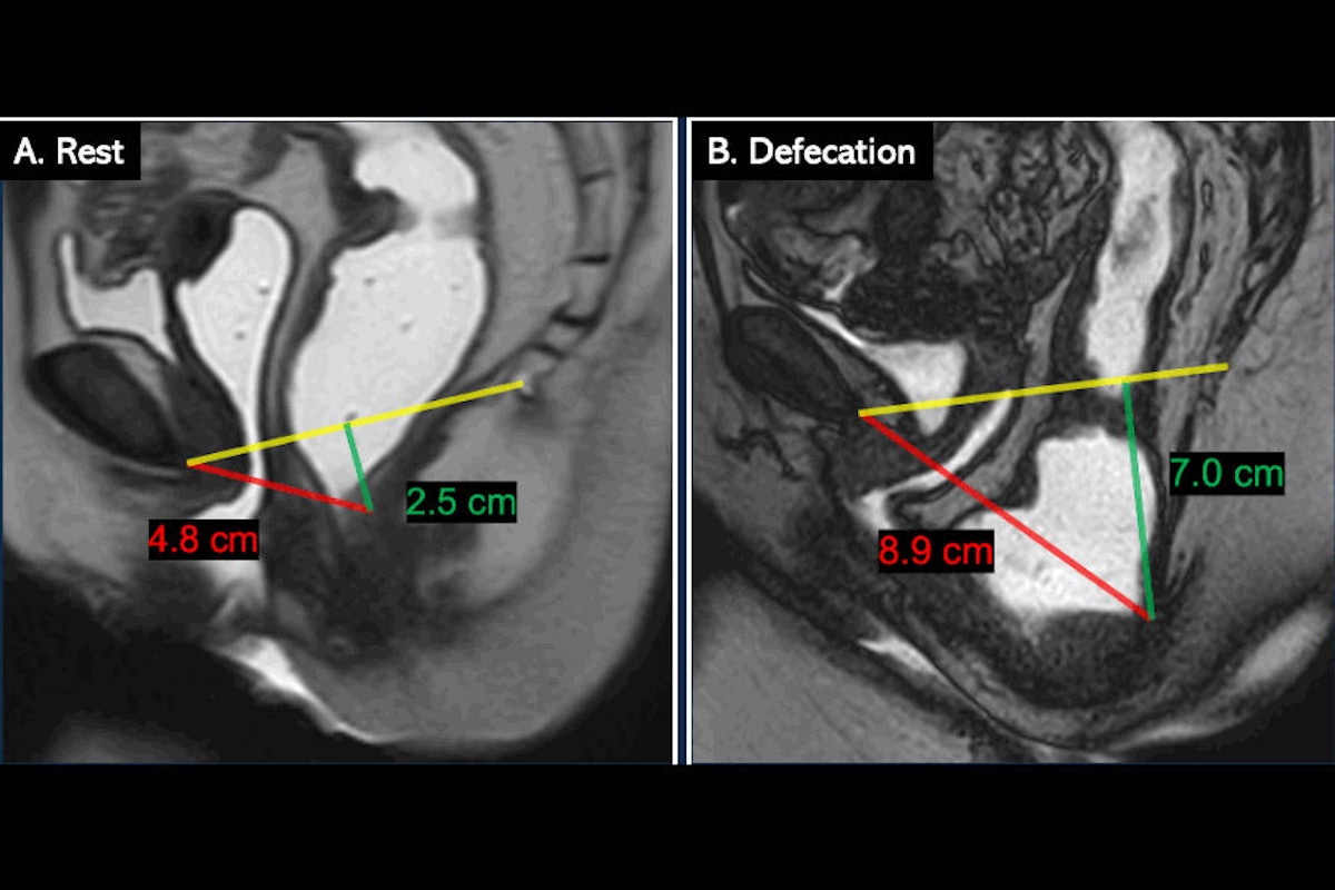 defecating mri