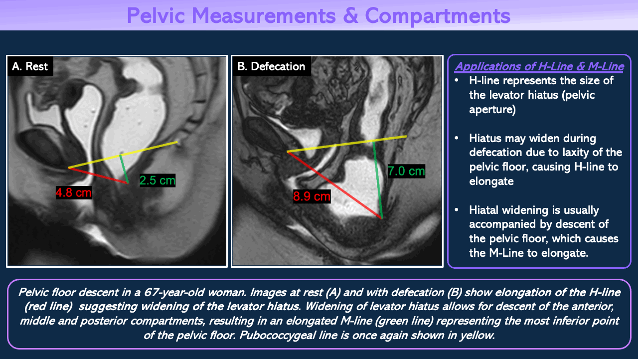 MRI proves value in pelvic floor disorders | AuntMinnieEurope