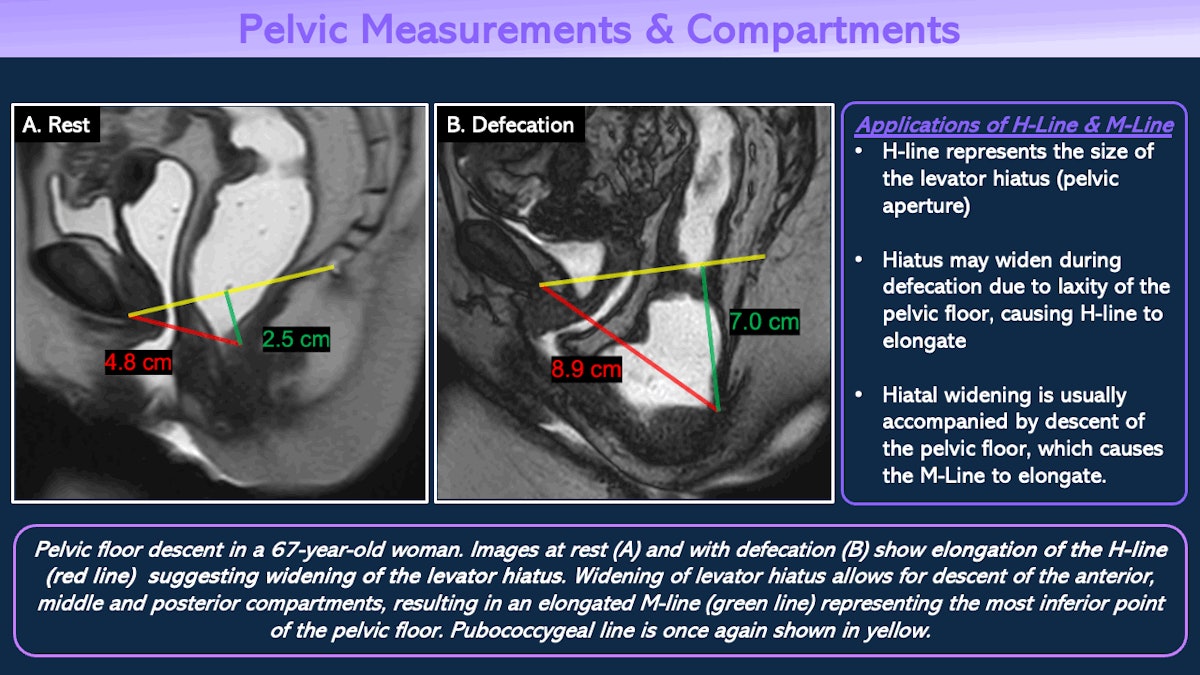defecating mri