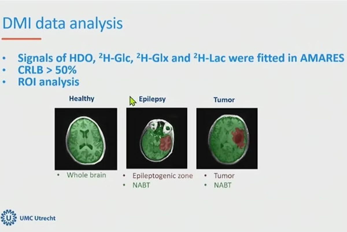 ISMRM: DMI metabolic modeling provides insight for neuro diseases ...