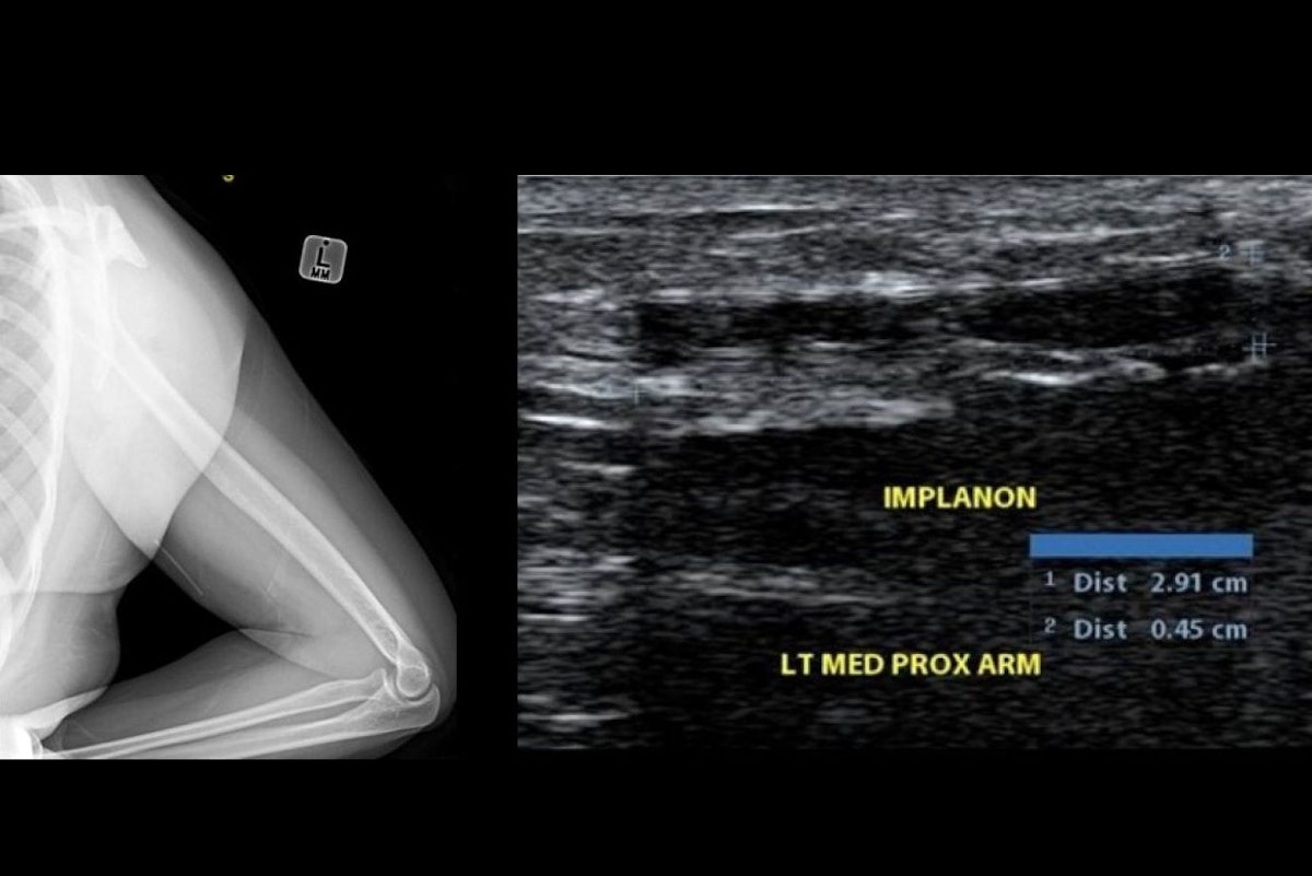 Foreign body imaging: X-ray overused, ultrasound underused ...