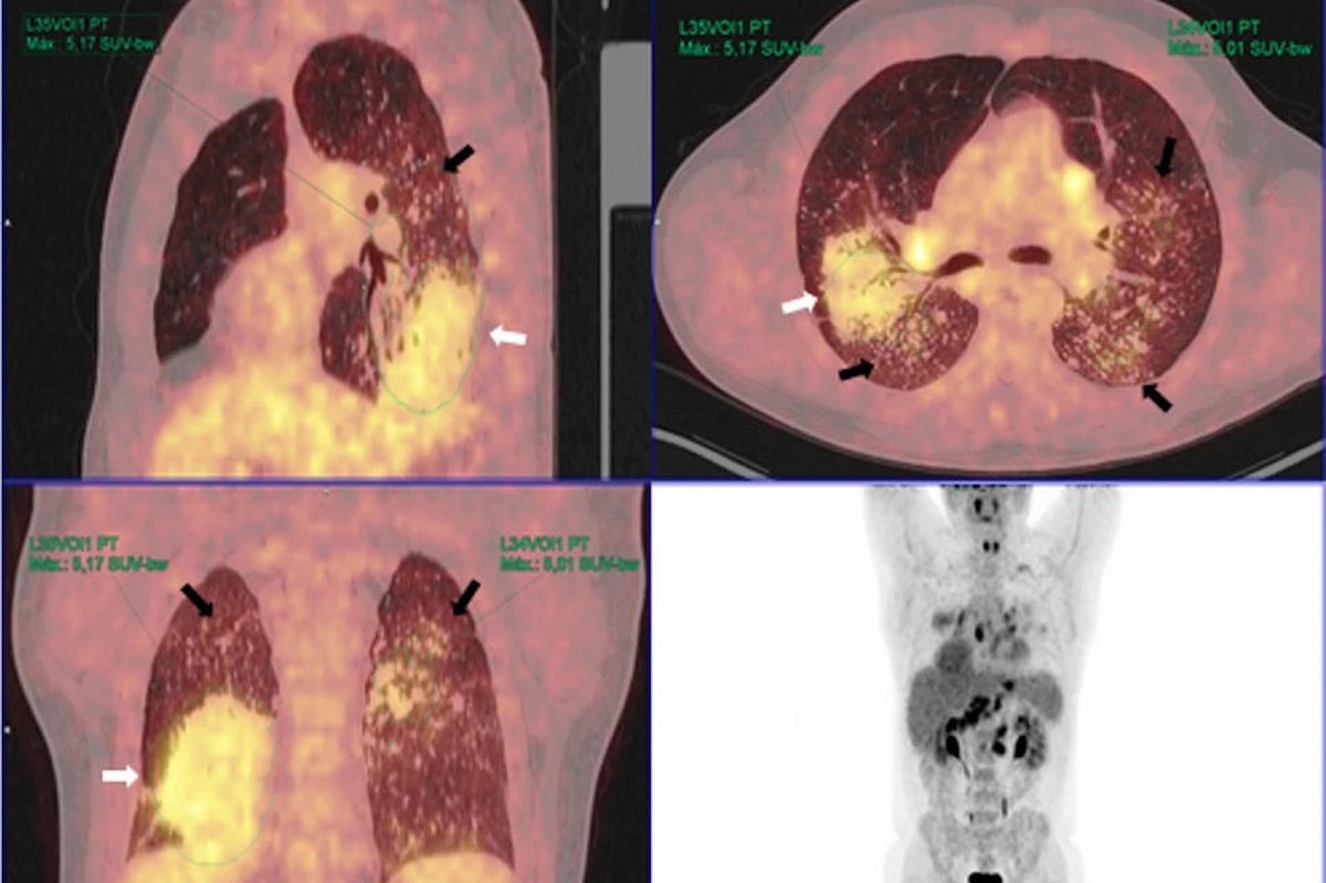 PET/CT scans show lung damage in stone workers | AuntMinnieEurope