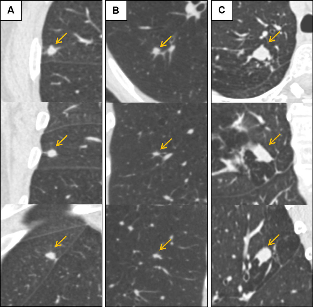 DL algorithm estimates lung nodule cancer risk, reduces false positives ...
