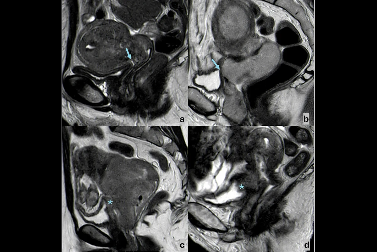 Momentum builds for MRI staging of cervical cancer | AuntMinnieEurope