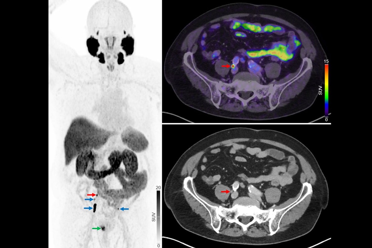 PSMA-PET/CT may replace NaF-PET/CT in advanced prostate cancer | AuntMinnieEurope