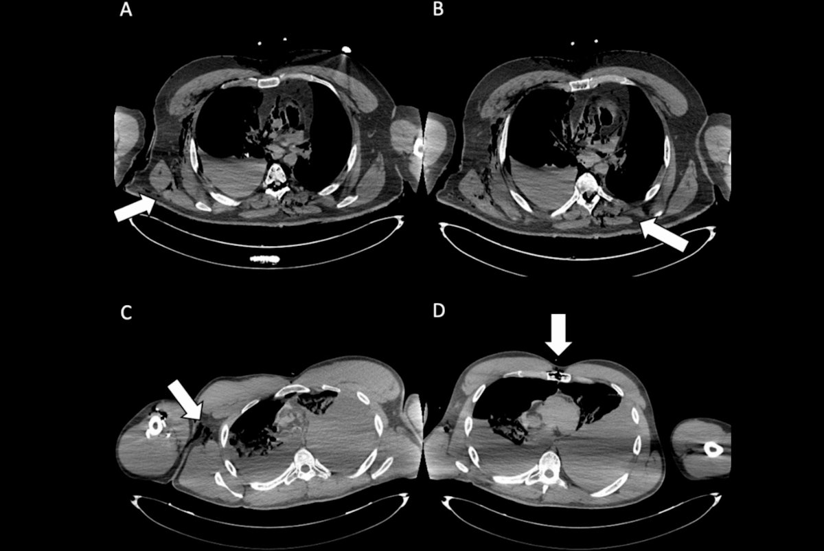 Team Sicily shines light on imaging of gunshot wounds | AuntMinnieEurope