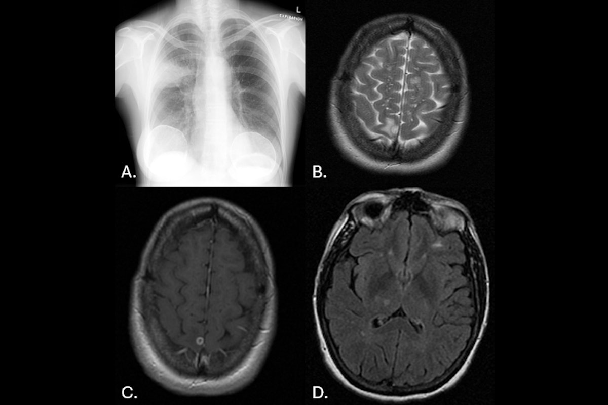 soap bubble lesions cryptococcus