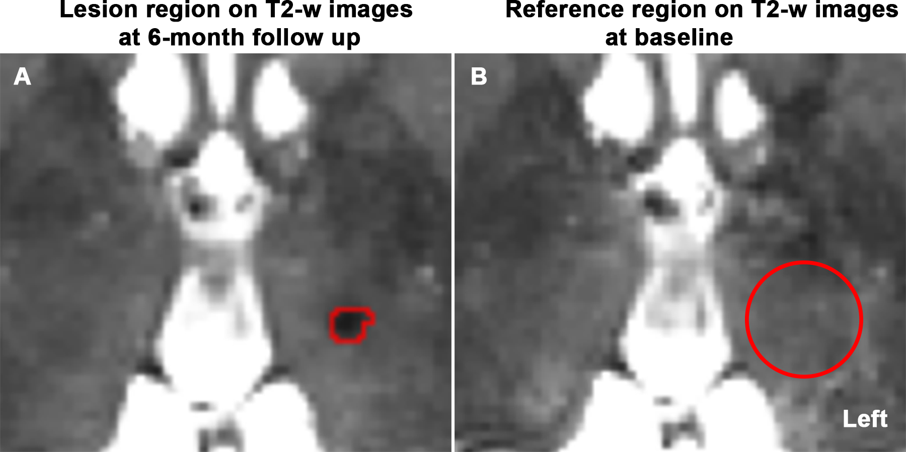 T1/T2-weighted MRgFUS ratio imaging improves brain lesion contrast ...