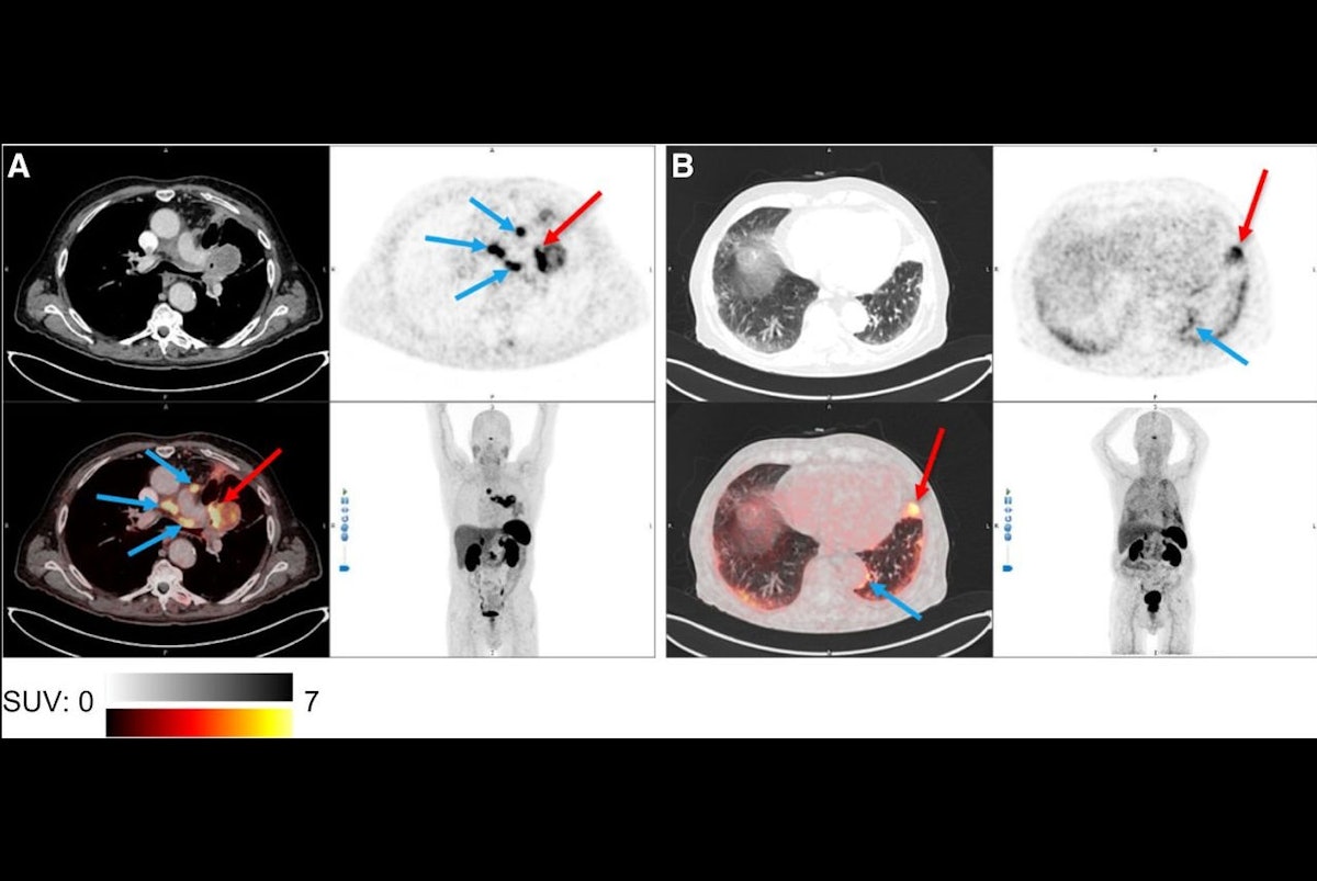 Theranostic pair ready for testing in lung cancer | AuntMinnieEurope