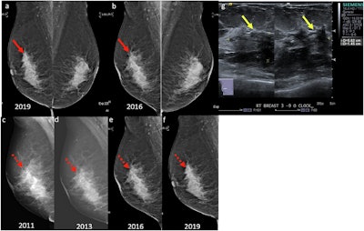 recalled from mammogram
