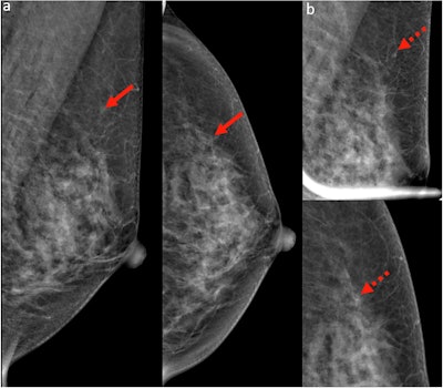 recalled from mammogram
