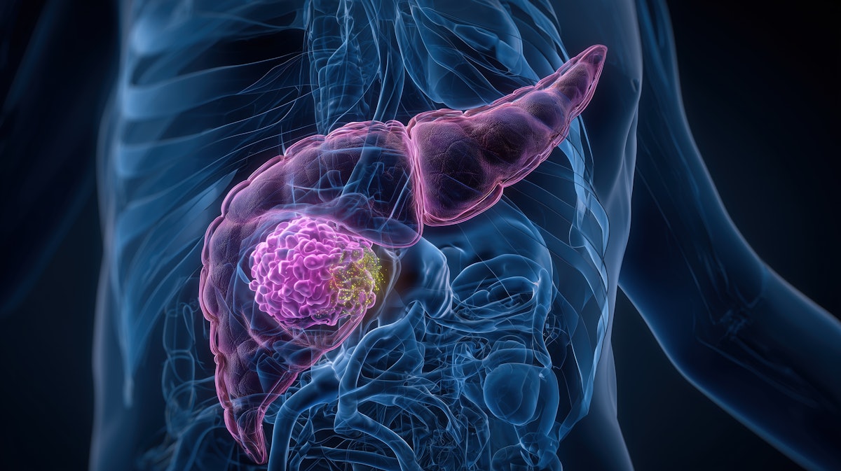Better CT reporting can boost care in pancreatic cancer | AuntMinnieEurope