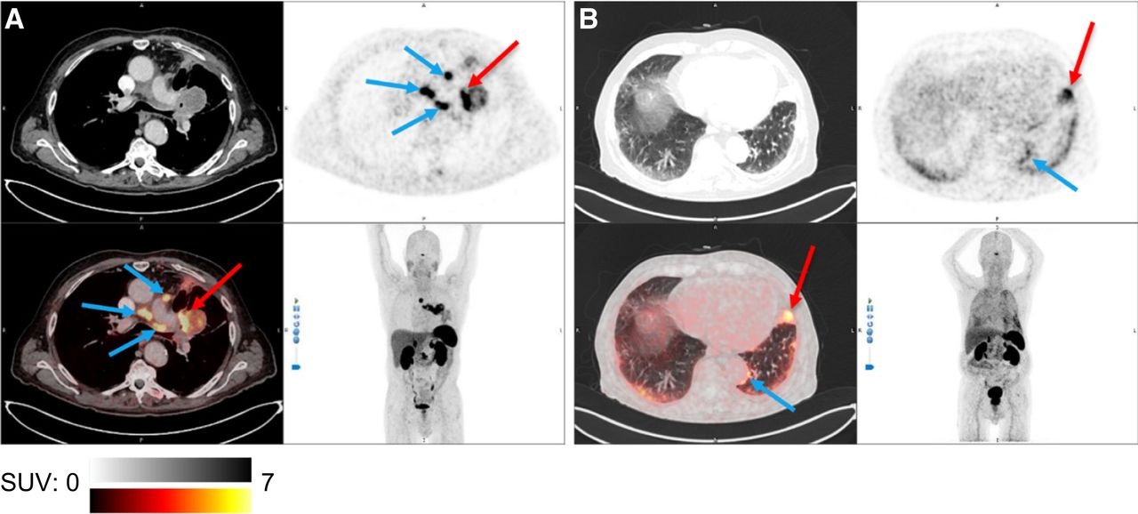 Theranostic pair ready for testing in lung cancer | AuntMinnieEurope