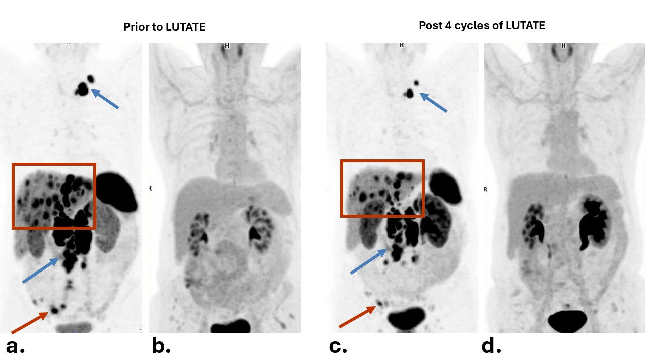 PET develops key clinical role in neuroendocrine tumors | AuntMinnieEurope